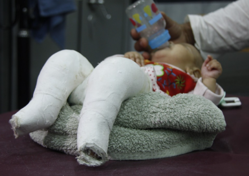 What Countries Have the Highest Clubfoot Relapse Rate? - Super Good Content
